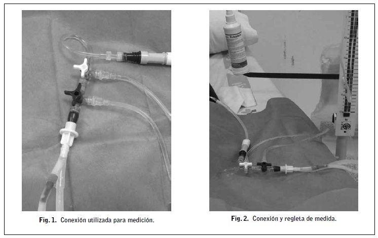 Presión intraperitoneal y ultrafiltración conseguida con diferentes ...
